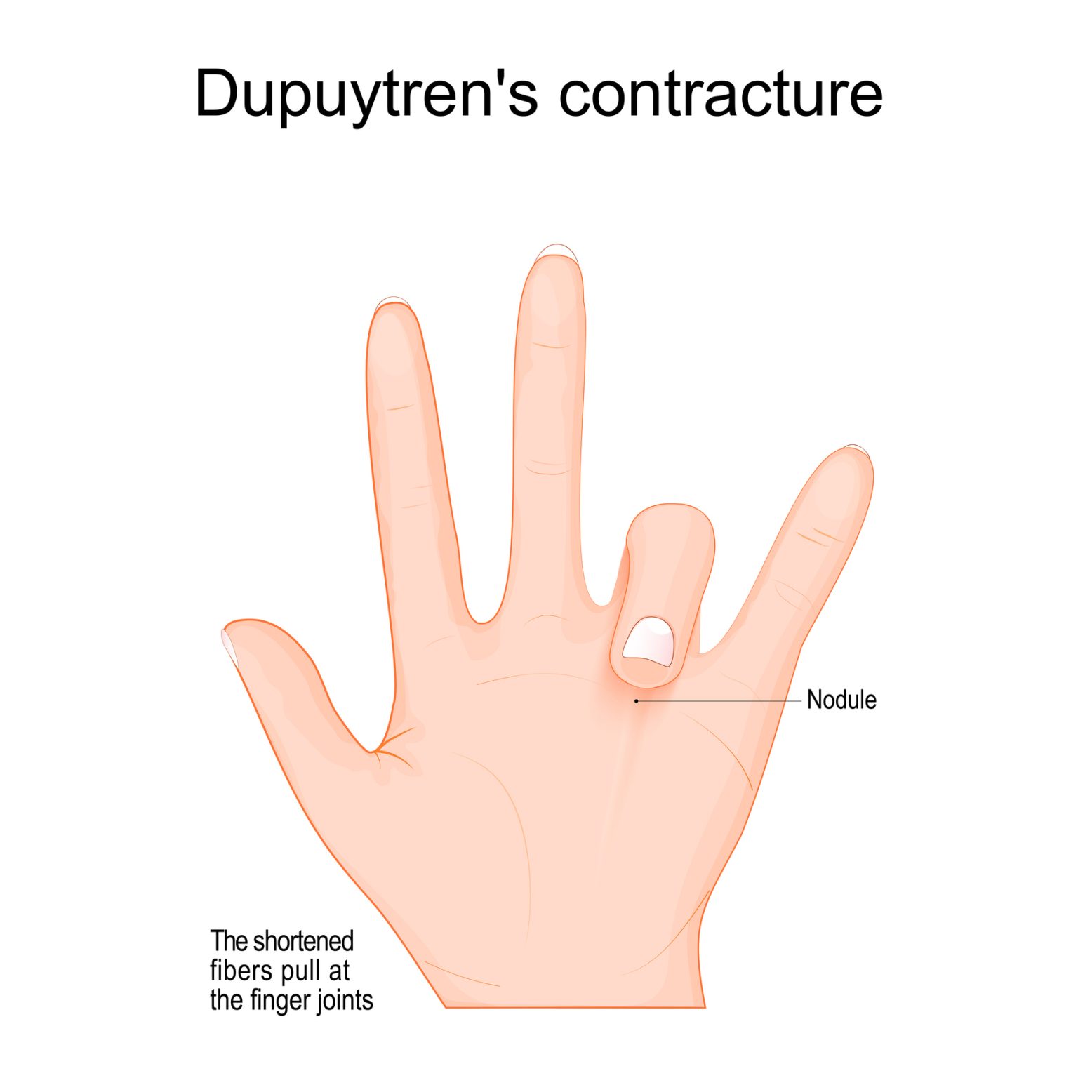 Dupuytren Contracture Release | Synergy Health Partners