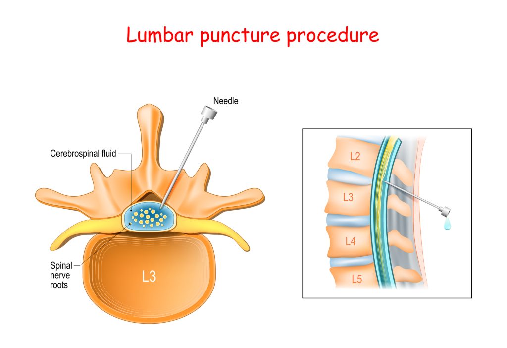 Lumbar Epidural Steroid Injection (Lumbar ESI) | Synergy Health Partners