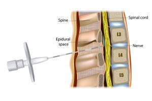 Lumbar Epidural Steroid Injection (Lumbar ESI) | Synergy Health Partners