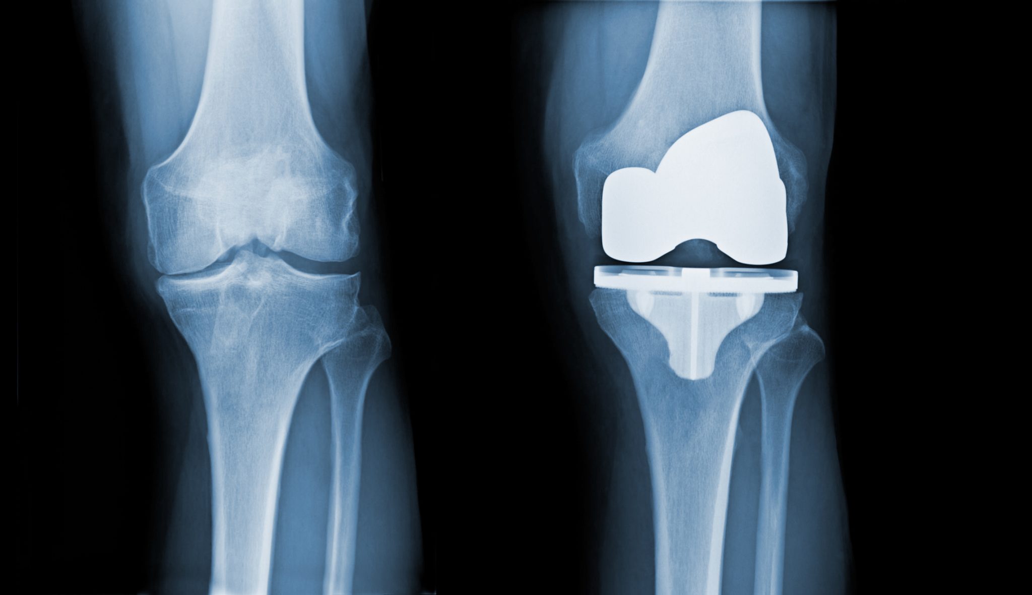 Total Knee Arthroplasty (TKA): Comprehensive Guide for Patients ...