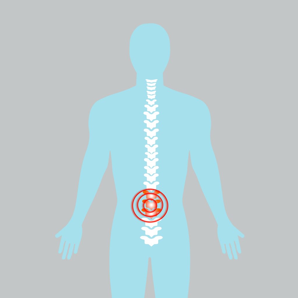 Lumbar RFA (Radiofrequency Ablation) | Synergy Health Partners