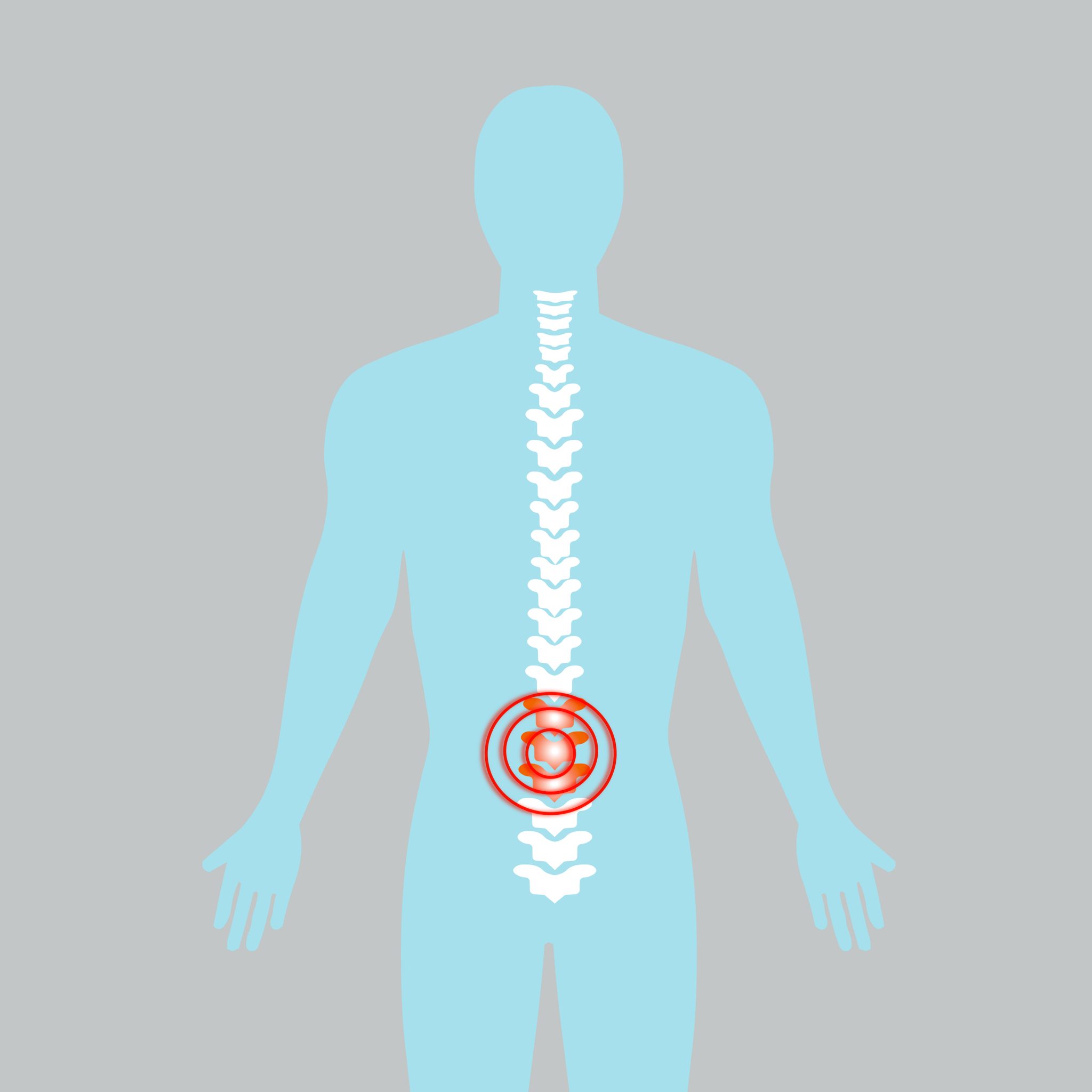 Lumbar RFA (Radiofrequency Ablation) | Synergy Health Partners