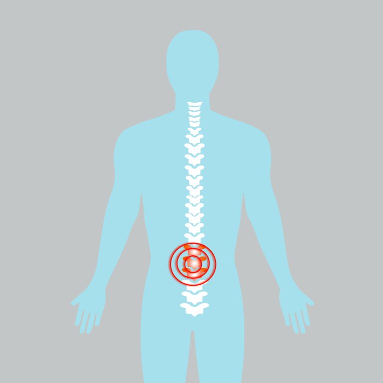 Lumbar RFA (Radiofrequency Ablation) | Synergy Health Partners