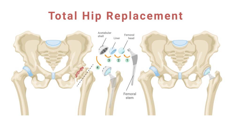Hip Replacement Revision Surgery | Synergy Health Partners