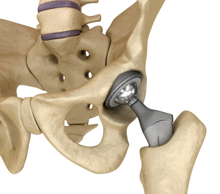 Hip Replacement Revision Surgery | Synergy Health Partners